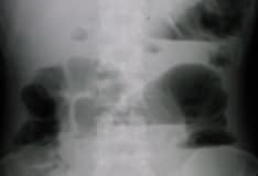 Intussusception Clinical Presentation: History, Physical Examination