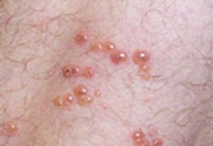 Pityriasis Rosea: Background, Pathophysiology, Etiology