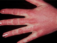 Raynaud Phenomenon Treatment & Management: Approach Considerations ...