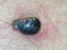 Seborrheic Keratosis Differential Diagnoses