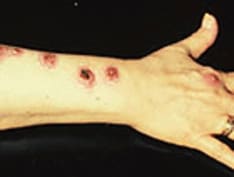 Mycobacterium Fortuitum: Background, Pathophysiology, Epidemiology