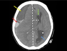 Brain Abscess Treatment & Management: Approach Considerations, Medical ...