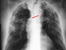 Farmer's Lung: Background, Pathophysiology, Etiology