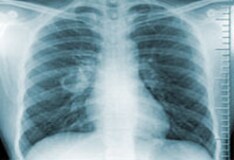 Primary Tuberculosis Imaging: Overview, Radiography, Computed Tomography