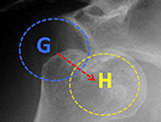 Reduction of Posterior Hip Dislocation: Background, Indications ...