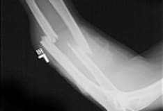 Fasciotomy: Overview, Preparation, Technique