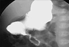 Midgut Volvulus Imaging: Overview, Radiography, Computed Tomography