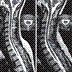 When Metals Compete: A Case of Copper-Deficiency Myeloneuropathy and Anemia
