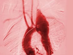 Aortic Dissection: Practice Essentials, Background, Anatomy