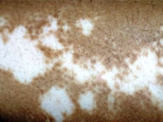 Acneiform Eruptions: Background, Etiology, Patient Education