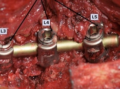 Lumbar Discectomy: Background, Indications, Contraindications