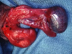 Oxlumo (lumasiran) dosing, indications, interactions, adverse effects ...