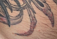 Tetracycline dosing, indications, interactions, adverse effects, and more