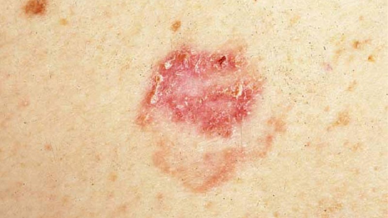 12 Rashes You Need to Know: Common Dermatologic Diagnoses