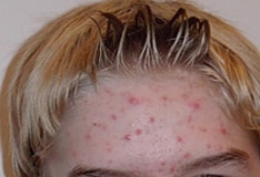 Pityriasis Lichenoides Clinical Presentation: History, Physical ...