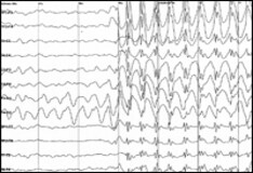 Aptiom (eslicarbazepine acetate) dosing, indications, interactions ...