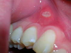 Kenalog Orabase (triamcinolone topical) dosing, indications ...