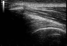Baker Cyst Imaging: Overview, Radiography, Computed Tomography