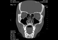 Glanzmann Thrombasthenia: Practice Essentials, Background, Pathophysiology