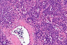 Platelet Disorders: Overview of Platelet Disorders, Pathophysiology of ...