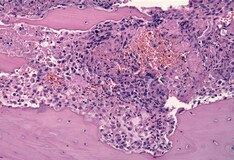 Reclast, Zometa (zoledronate) dosing, indications, interactions ...