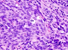 Velban (vinblastine) dosing, indications, interactions, adverse effects ...