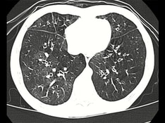 azithromycin fda warning