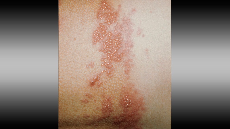 Hidden Heart Disease: 19 Dermatologic Clues You Should Know