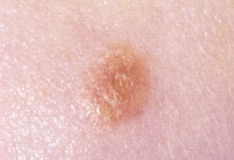 Atypical Mole (Clark Nevus or Dysplastic Nevus): Background ...