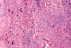 Systemic Lupus Erythematosus (SLE): Practice Essentials ...