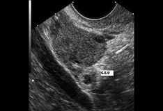 Subchorionic Hemorrhage Imaging: Practice Essentials, Computed ...