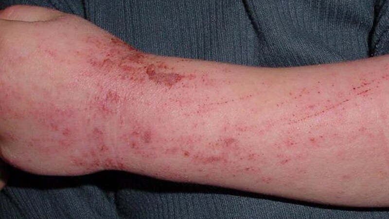 Atopic Dermatitis | Medscape