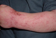 A 43-Year-Old Man With Severe Itching and Hyperlipidemia