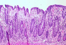 Collagenous and Lymphocytic Colitis: Background, Pathophysiology, Etiology