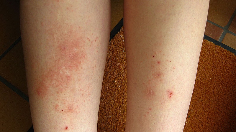 Psoriasis | Medscape