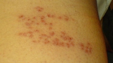 Herpes Zoster Workup: Approach Considerations, Laboratory Studies ...
