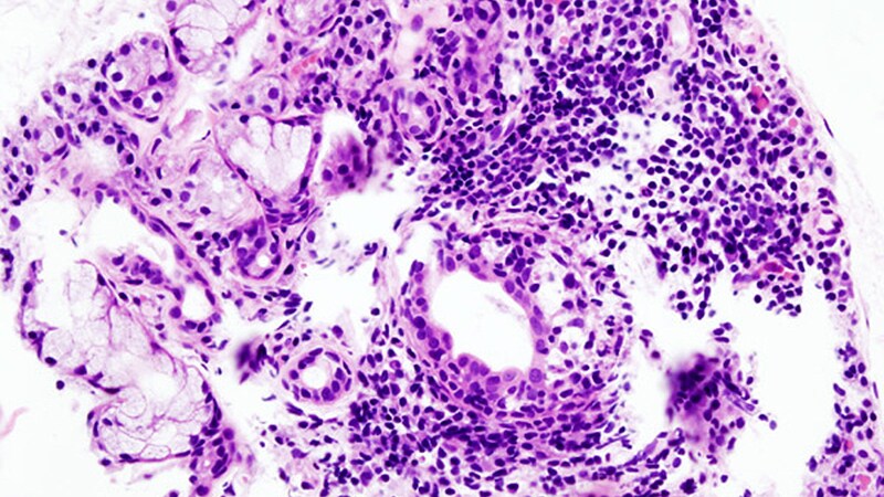 Sjögren's Syndrome | Medscape