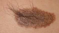 Melanocytic Nevi Differential Diagnoses