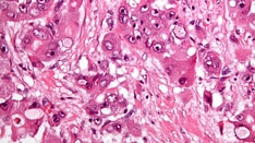 nexavar side effects