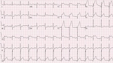 TNK tPA, TNKase (tenecteplase) dosing, indications, interactions ...