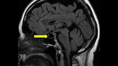 On Strike or Working Overtime: 13 Endocrine Emergencies