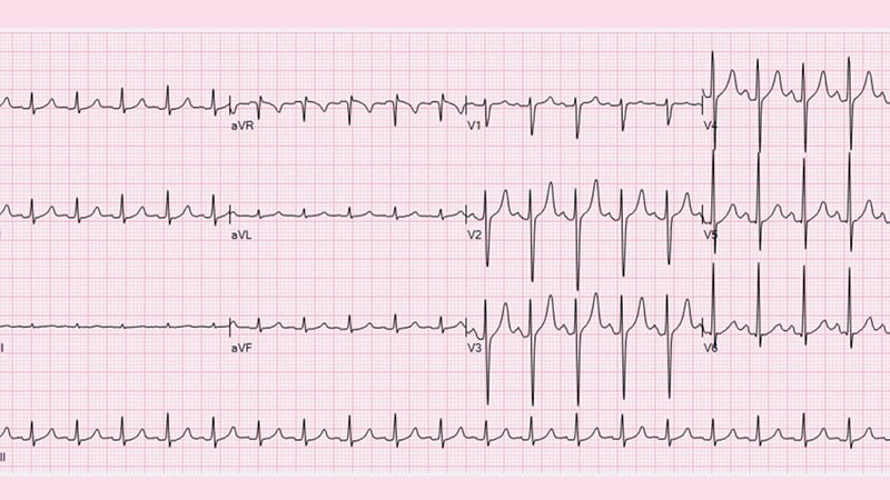 A 60-Year-Old Woman With Worsening Hypertension - Page 2