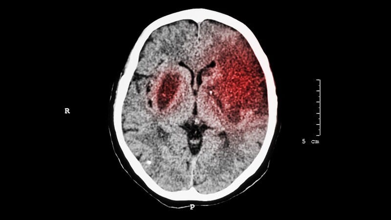 Fast Five Quiz: Stroke