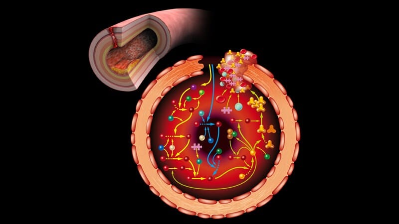 Fast Five Quiz: Direct Oral Anticoagulant Therapy for AF