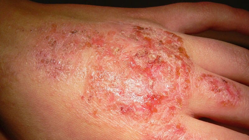 Fast Five Quiz: Severe Atopic Dermatitis in Adults