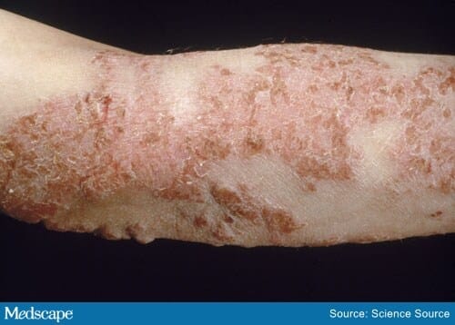 Fast Five Quiz: Atopic Dermatitis Management