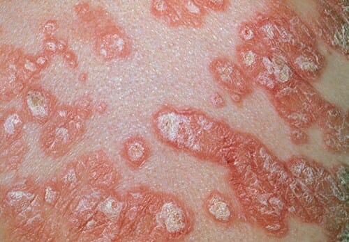 Skill Checkup: A 27-Year-Old Woman With Erythematous Plaques