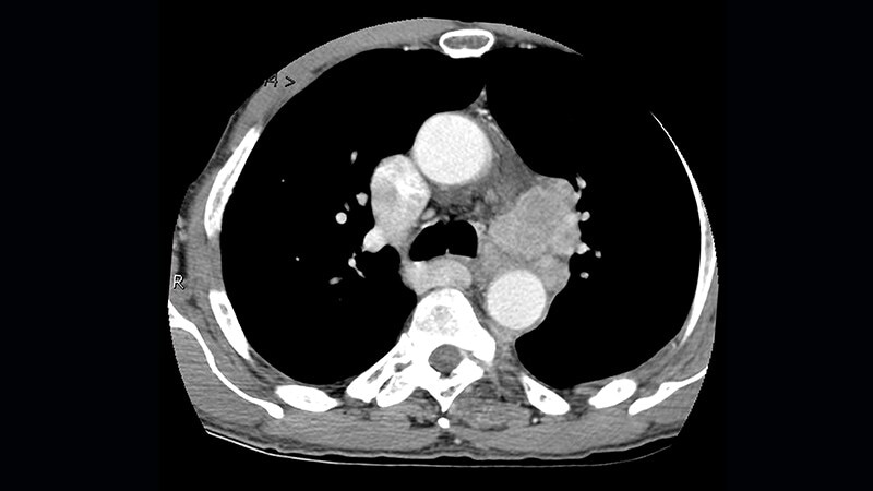 Fast Five Quiz: Metastatic Non-Small Cell Lung Cancer