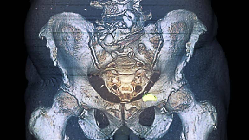 Fast Five Quiz: Metastatic CRPC Management