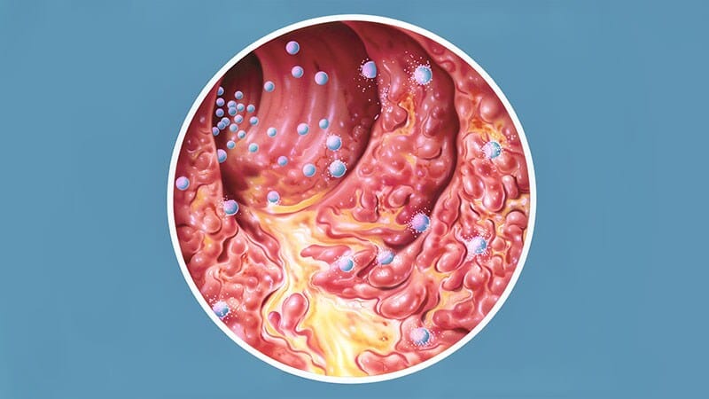 Fast Five Quiz: Identifying Ulcerative Colitis